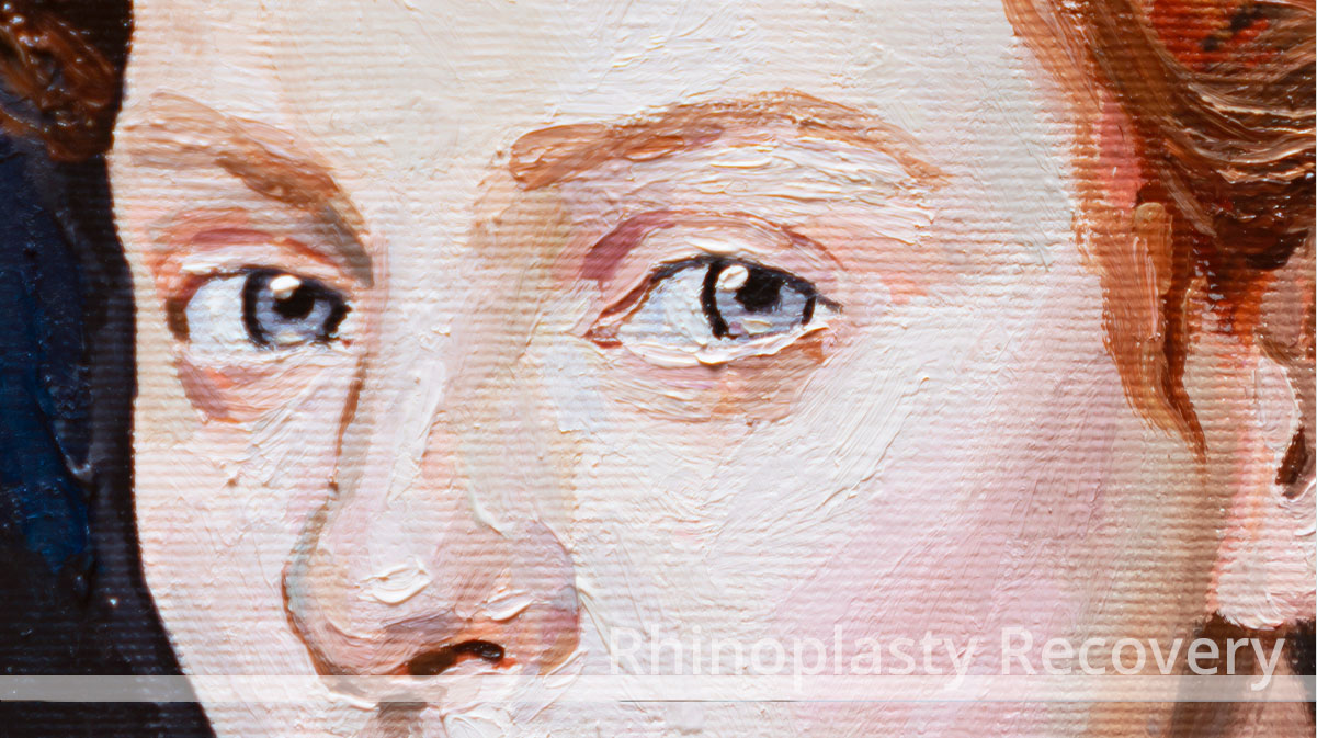 Rhinoplasty: Recovery Timeline, Tips, and Precautions